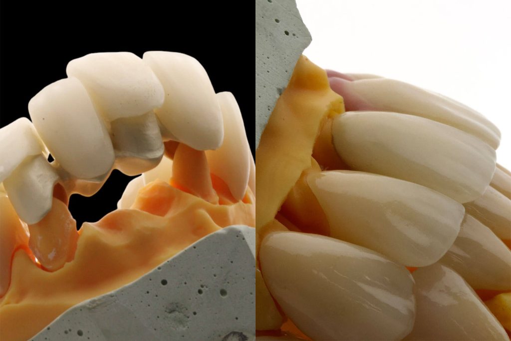Dental Crown And Bridges Malaysia | mydentist®